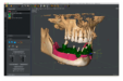 Quickvision 3D Implant planning software - Owandy Radiology