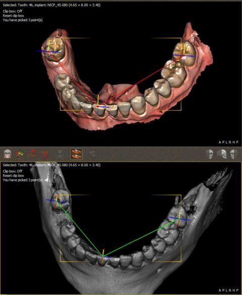 Quickvision 3D Implant planning software - Owandy Radiology