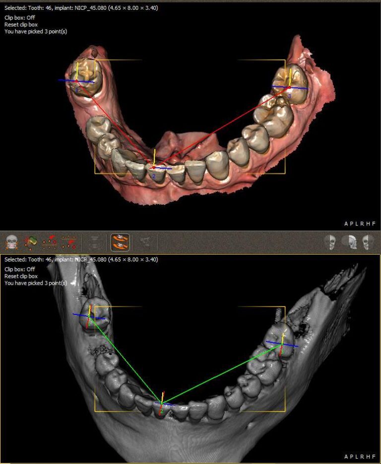 Quickvision 3D Implant planning software - Owandy Radiology